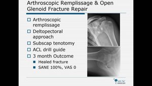 Anterior Shoulder Instability in 2025: Consider Buttons vs. Screws and ...