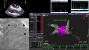 Paroxysmal AFib With Typical Flutter: High-Resolution Farapulse PVI and ...