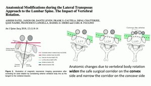 How Do You Select Approach Side and Minimize Risk of Pseudohernia and ...