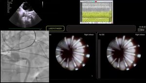 Balloon-Based PFA for Paroxysmal AF: Minimalistic ICE-Guided Workflow ...