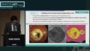 Long-Term iPSC-Derived RPE Sheet Engraftment in Neovascular AMD: 10 ...