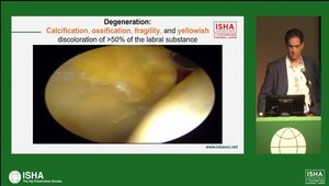 Labral Tears: Forms of Injury More Complex Than a Tear | Vumedi