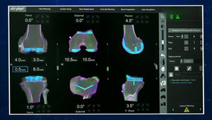 Mako Robotic-Arm Assisted Severe Varus Knee Replacement: Surgical ...