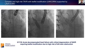 Mechanical Cardiocirculatory Support in Structural Heart | Vumedi