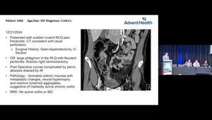 IBD Case 5: Crohn’s Disease After Surgical Emergency | Vumedi