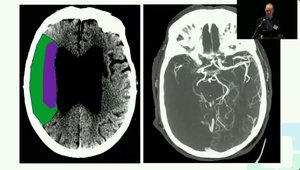 The Evolution of Stroke Imaging During the Interventional Revolution ...