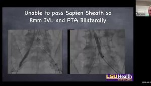 TCT 2025 Insights: Tips and Tricks for Challenging Access to the Aortic ...