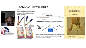 Electrosurgery Leaflet Modification | Vumedi