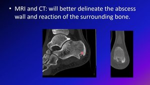 Brodie’s Abscess in Children: Pathology, Imaging, and Management | Vumedi