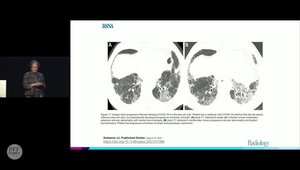 Post-COVID ILD: Presentation, Pathogenesis and Future Implications | Vumedi