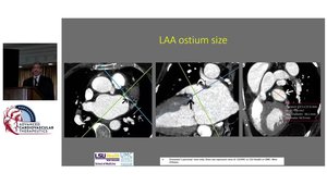 Preprocedure and Post Procedure CT Imaging of the LAA Closure Devices ...