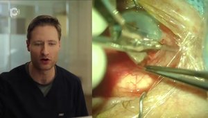 Gundersen Flap for Neurotrophic Ulcer – Our Current Technique | Vumedi