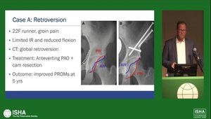 Treatment Algorithms for Acetabular Retroversion, Anteversion and Under ...