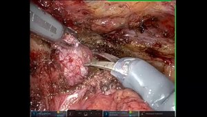 Robotic-Assisted Bladder Neck Reconstruction for Recurrent Bladder Neck ...