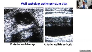 Important Findings in Upper Extremity Venous Duplex Mapping Before ...