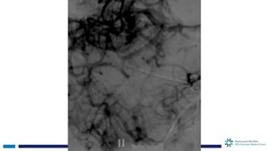 Dr. Brian Jankowitz: Interactive Case Presentation on Subarachnoid ...