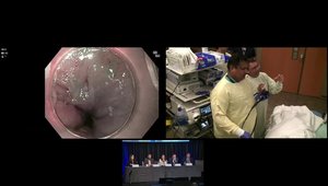 Live EGD with Radiofrequency Ablation (RFA) for Intestinal Metaplasia ...