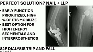 Distal Femur Peri-Implant Fractures: Nail? Plate? Nail-Plate? Revise ...