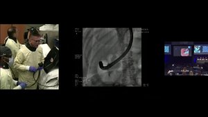 Live ERCP with Cholangioscopy for Suspected Mass in Common Bile Duct ...