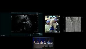 Live EUS Guided Pancreatic Cyst Drainage and Necrosectomy | Vumedi