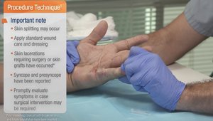 5th finger 30º MP and 50º PIP joint contractures: Treatment and ...