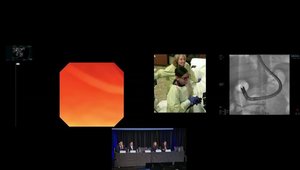 Live ERCP through Gastro-Gastric LAMS | VuMedi