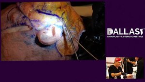 Deep Layer Facelift Techniques - How to Inject the Key Fat Compartments ...