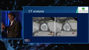 Leaflet Modification in Native Aortic and Valve-in-Valve TAVR: Patient ...