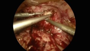 Laparoscopic Drainage of a Tubo-ovarian Abscess | VuMedi