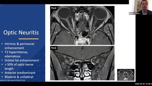 MOGAD Awareness Month 2025: MOG Antibody Disease on MRI | VuMedi