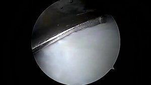 Rotator Cuff Repair & Biceps Tenodesis With Synthetic Nanofiber ...