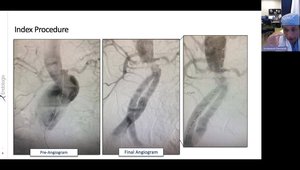 EVAR in Short and Angulated Aortic Necks: A Case-Based Review with the ...