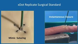 Novel Vascular Closure Device (xDot) - First in Human Experience | Vumedi