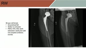 Lower Extremity Case Discussions: Revision THA on 90 y/o? | Vumedi