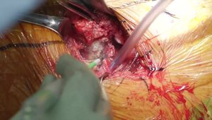 Direct Anterior Total Hip Arthroplasty Through Bikini Style Incision ...