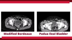 EAU25 Insights: Robotic Intracorporeal Modified Bordeaux vs Padua Ileal ...