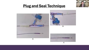 CRT 2025 Insights: The “Plug and Seal” Technique in Distal Coronary ...