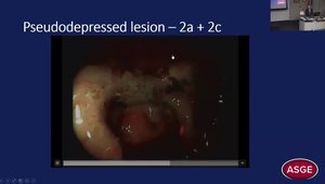 Endoscopy of Polyps A to Z | Vumedi