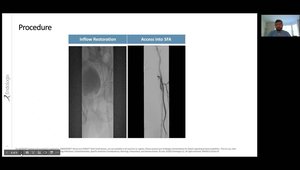 Treating Complex PAD with PTAB Using the DETOUR System: Patient Case ...