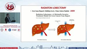 Different Dosimetric Approaches for Optimizing Radioembolization (Y-90 ...