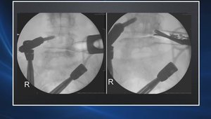 Camera-Enhanced Tubular Surgery: Mid-Step to Endoscopy | Vumedi