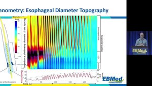 How I Do It: Esophageal Diagnostics with EndoFLIP, Bravo, and Manometry ...