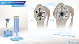 Surgical Animation: Anatomic Shoulder Arthroplasty with OsseoFit ...