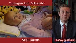 Tubingen Hip Flexion and Abduction Orthosis Application | Vumedi