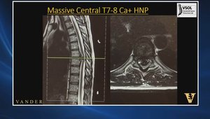 Thoracic Endoscopic Discectomy for Calcified Giant Thoracic HNP's: A ...