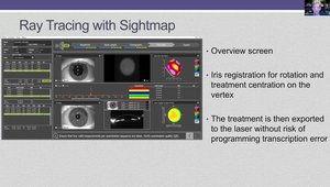 ASCRS 2025 Insights: A New Ray Tracing-Based Algorithm for Treatment of ...