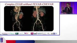 EVAR Is Better Than Open Repair for RAAAs | Vumedi