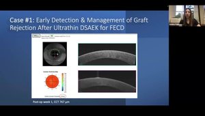 ASCRS 2025 Insights: Long-Term Telemonitoring of Corneal Grafts via ...