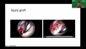 AutoCart Technique for Acetabular Chondral Lesions in Hip Arthroscopy ...