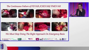 The Negative Impact on Cardiovascular Hemodynamics: Lessons of TEVAR ...